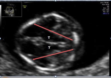 Ultrasound Image Showing The Two Thalami T And The Two Cerebral