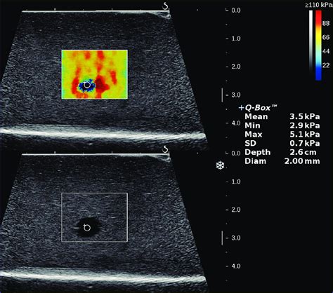 Elastogram Of Unechogenic Cyst Like Inclusion Showing Values Of Content