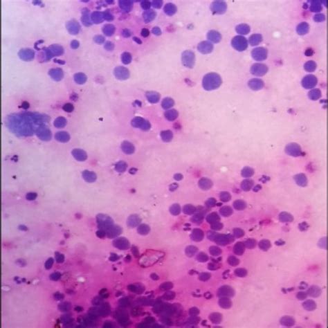 Peritoneal Fluid Having Reactive Mesothelial Cells As Well As Mixed