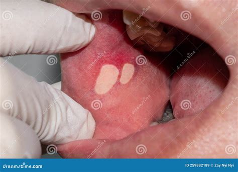 Aphthous Ulcer Or Stress Ulcer In Mouth Of Asian Patient Stock Image