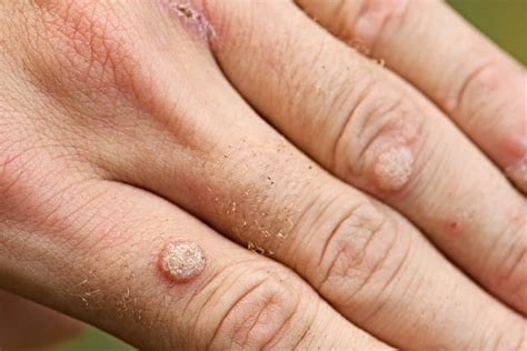 Warts New Drug Loft And VLS Pharmacy
