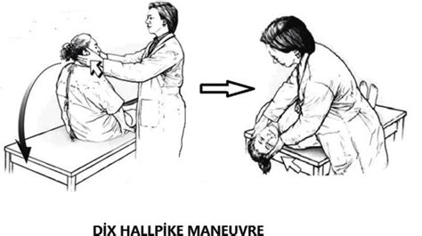 Dix Hallpike Maneuver Nystagmus In Addition To Severe Vertigo Download Scientific Diagram