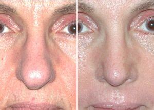 Nasal Tip Projection And The Nasolabial Angle In Rhinoplasty Explore