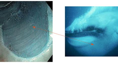 Classifications Endoscopy Campus