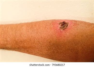 86 Imagens De Black Lesion Scab Imagens Fotos Stock E Vetores
