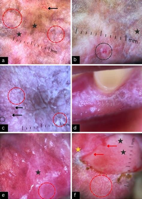 Oral Lichen Planus Mucoscopic Perspective Journal Of Skin And
