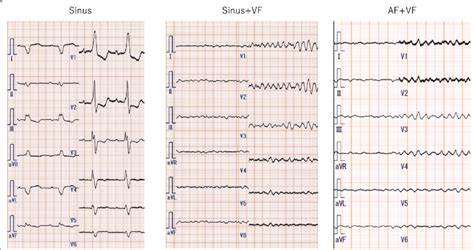 Ventricular Fibrillation Vs Atrial Fibrillation
