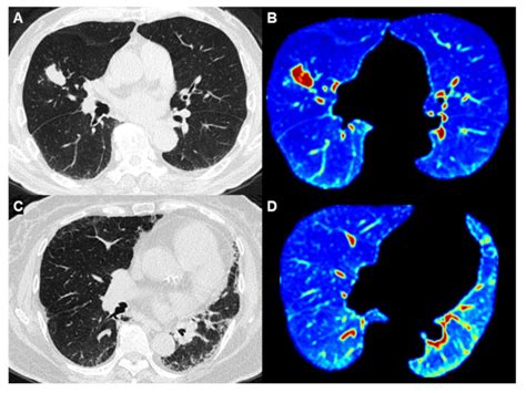Quantification Of Cancer Developing Idiopathic Pulmonary Fibrosis Using