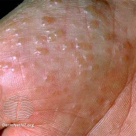 3 Reasons Not To Pop Dyshidrotic Eczema Blisters Myeczemateam