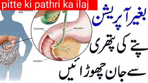 Pittay Ki Pathri Ka Ilaj In Urdu I Pittay Ki Pathri Ka Ilaj I Pitay Ki Pathri Ka Ilaj Youtube