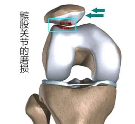 膝盖髌骨软骨磨损可以恢复吗？ 知乎