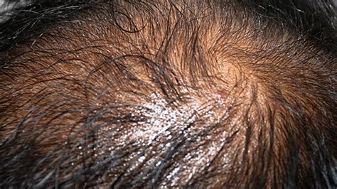 Common Types Of Scalp Problems TrichoLab