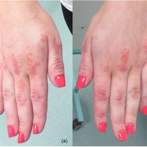 Symmetrical Ill‐defined Erythema Of The Lateral Thighs Consistent With Download Scientific