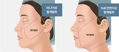 서울동안의원 포인트리프팅 볼·팔자·입가