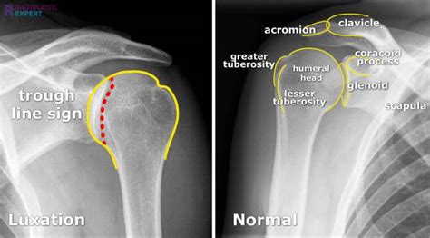 Humerus X Ray Intraoperative Imaging Of The Proximal Humerus