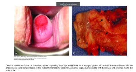 Ob Block 1 Lecture 5 Cervical Disorders And Neoplasms Summer