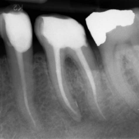 Kreena Patel On Linkedin Endodontics Endo Saveteeth Endodontia Rootcanal