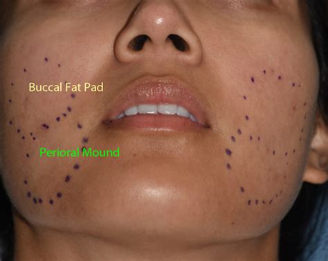 Facial Fat Removal With Combined Buccal Lipectomies And Perioral Mound