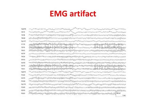Eeg Artifacts