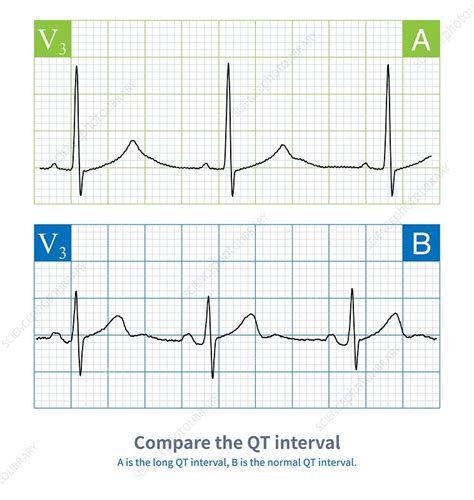 QT Interval Comparison Illustration Stock Image C Science Photo Library