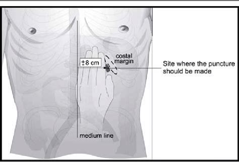 Schematic Illustration Showing Veress Needle Puncture In The Left Download Scientific Diagram