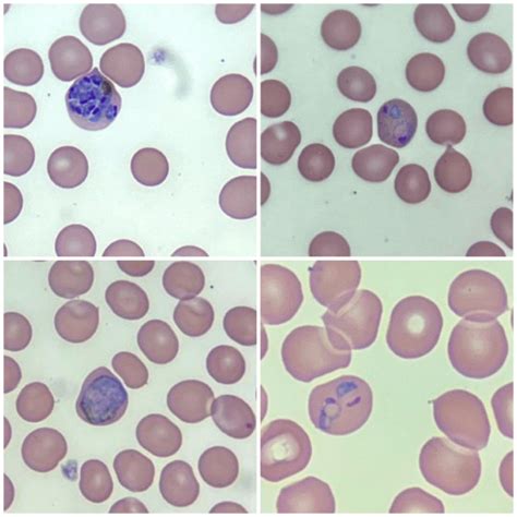 Plasmodium Ovale