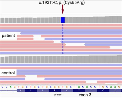 Bam File Showing The Gpihbp1 Nm 178172 5 C 193t C P Cys65arg