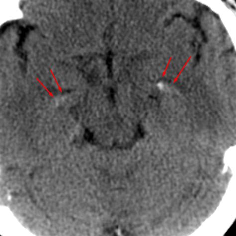 Choroid Plexus In The Temporal Horn