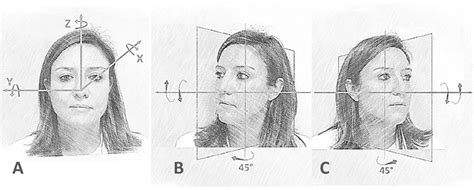 Minimum Stimulus Strategy In The Diagnosis Of Bppv Interview 28622