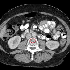 Management Algorithm For Osteopenia On Abdominal CT Download Scientific Diagram
