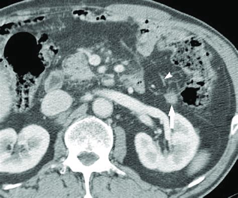 Locoregional Recurrence In A 72 Year Old Man Who Had Undergone Left Download Scientific Diagram