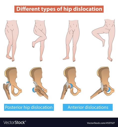 Different Types Of Hip Dislocation Royalty Free Vector Image Different Types Of Hip Dislocation Royalty Free Vector Image