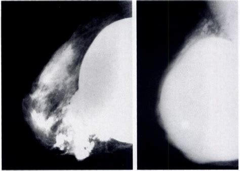 Film Screen Mammograms Show Rupture Of Breast Implants A Large