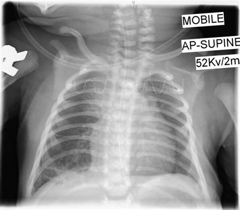 Pulmonary Sequestration