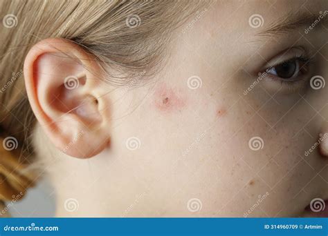 Staphylococcal Streptococcal Skin Infection Or Bullous Impetigo And