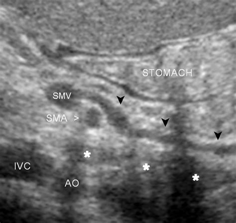 Inferior Mesenteric Artery Ultrasound Superior And Inferior Mesenteric