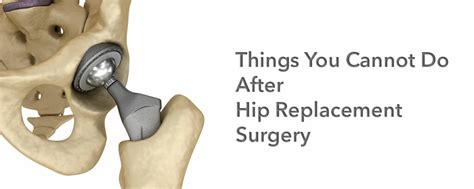 Things You Cant Do After Hip Replacement Surgery What Not To Do After