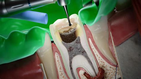 Root Canal Treatment Vokas 3d Medical Animation Portfolio