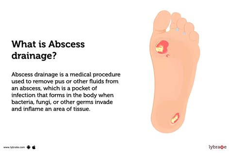 Abscess Drainage