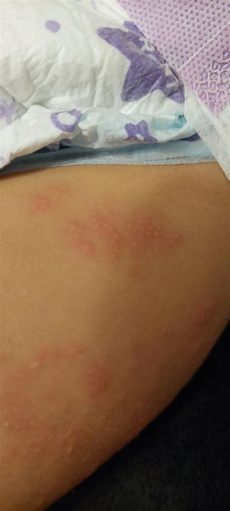 My Shingles Timeline Started With Severe Back Pain Rshingles