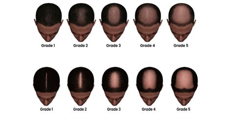 Top 8 Signs Of Balding How To Spot It Early And What It Means