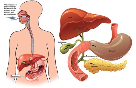 Endoscopic Retrograde Cholangiopancreatography