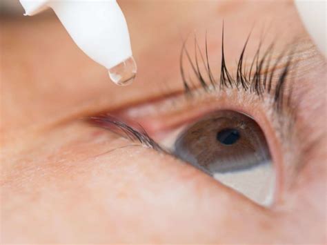 Staphylococcal Blepharitis