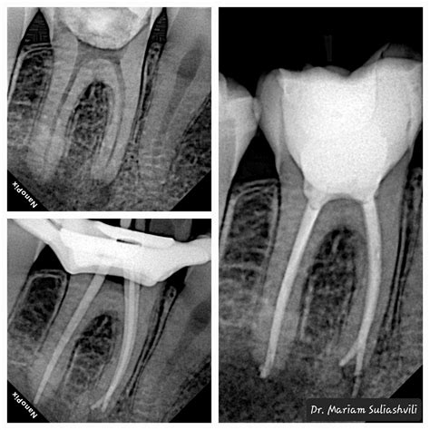 🦷 ️პაციენტი 16 წლის მოგვმართა მწვავე ტკივილით რომელსაც თან ახლდა შესიება 🦷დიაგნოზი მწვავე