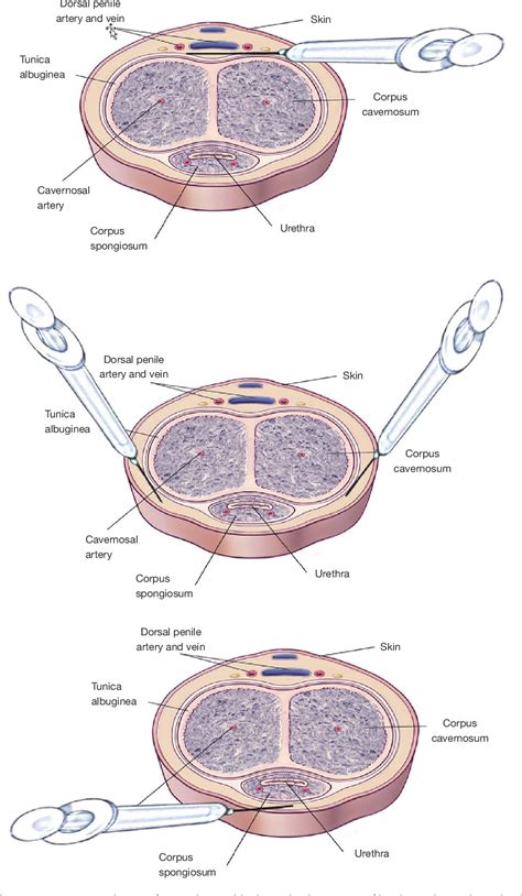 Figure 1 From Long Acting Liposomal Bupivacaine And Postoperative Opioid Use After Peyronies