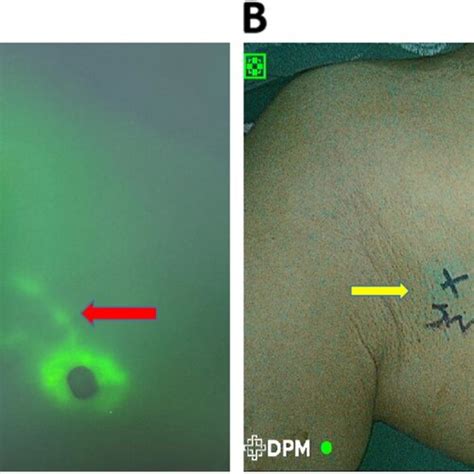 Fluorescent Subcutaneous Lymph Vessels Red Arrows And The Marked Sln Download Scientific