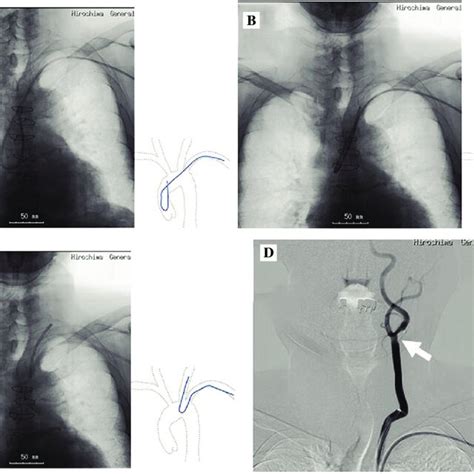 A Fluoroscopic View Showed Stent Deployment B Fluoroscopic View