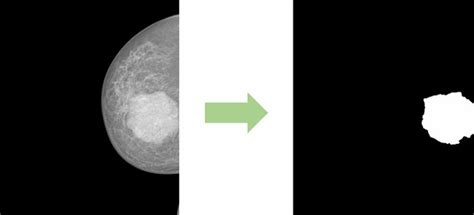 Mammogram Image With Mass And Corresponding Segmented Region Download