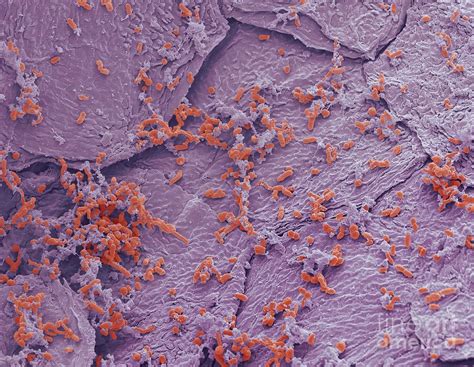 Bacterial Skin Infection Photograph By Steve Gschmeissnerscience Photo