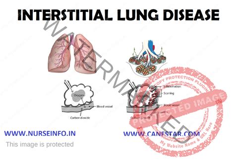 Interstitial Lung Disease A Review Fipk